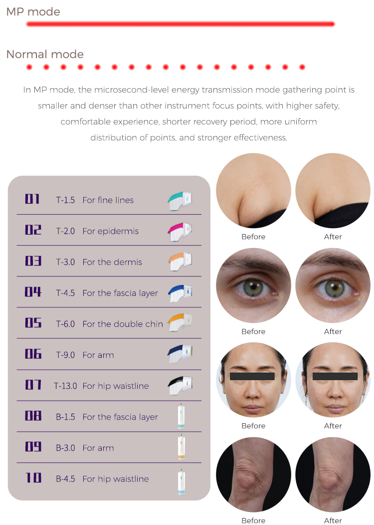 Ultra MPT HIFU Machine Non-invasive Facelift Skin Tightening Body ...