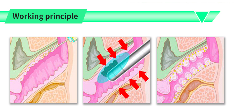 Ultraformer Ultralif 3 Machine Price 2 in 1 2d5d6d9d Hifu Machine from China manufacturer ...